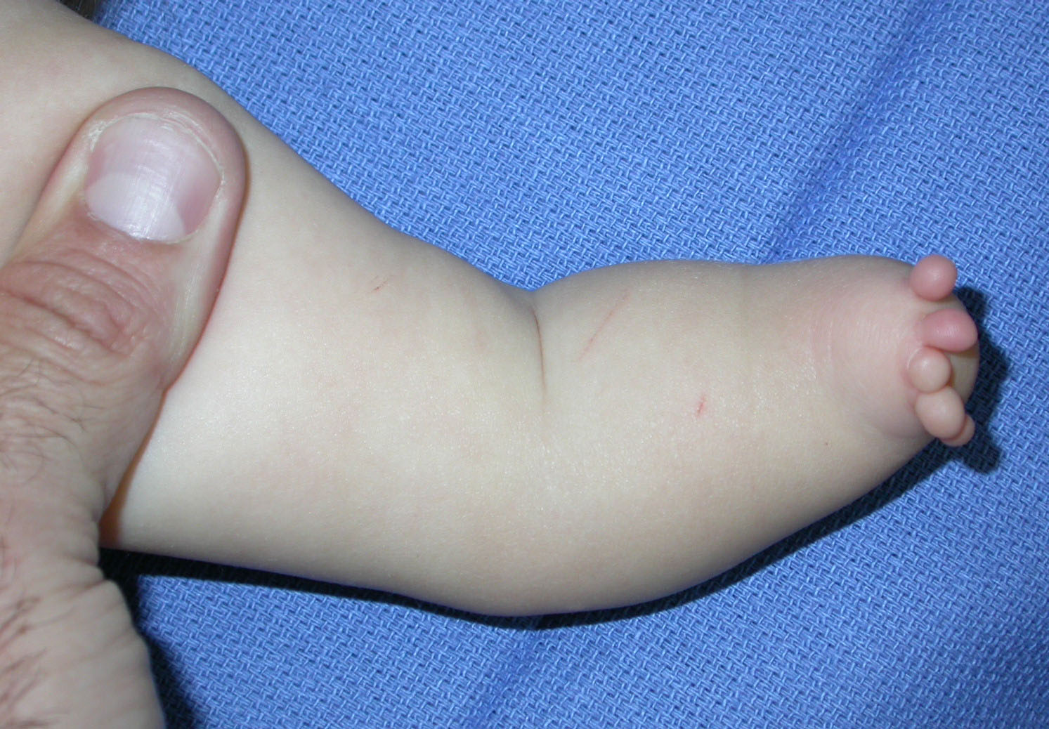 Severe Symbrachydactyly and Nubbins | Congenital Hand and Arm ...