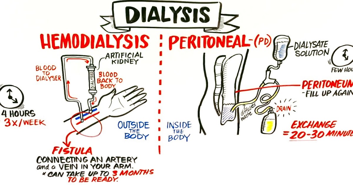 ASK DIS: Types of Hemodialysis