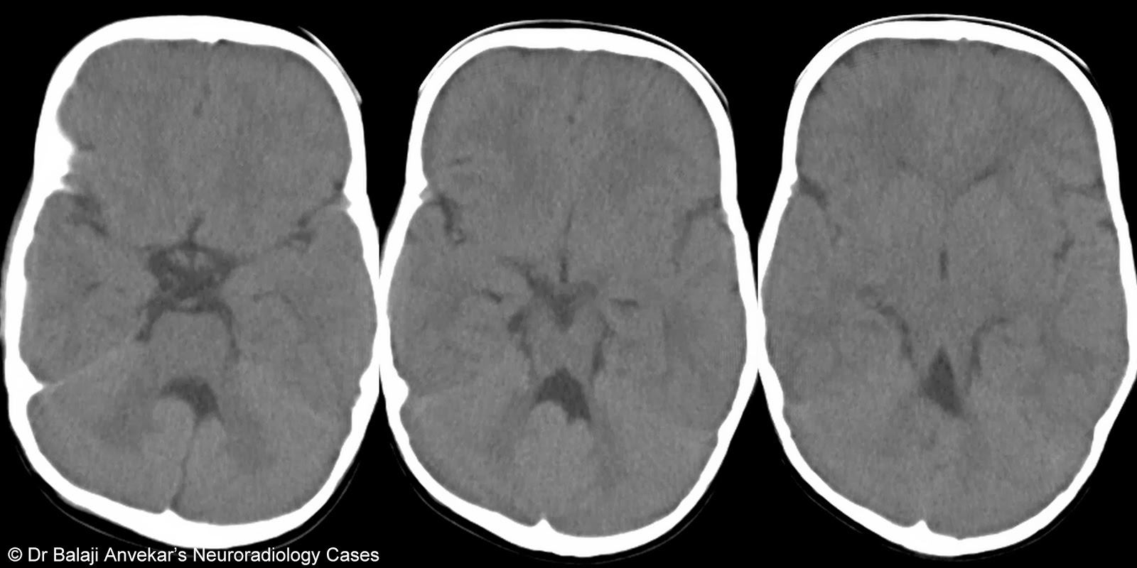 Dr Balaji Anvekar FRCR: Joubert Syndrome CT Brain