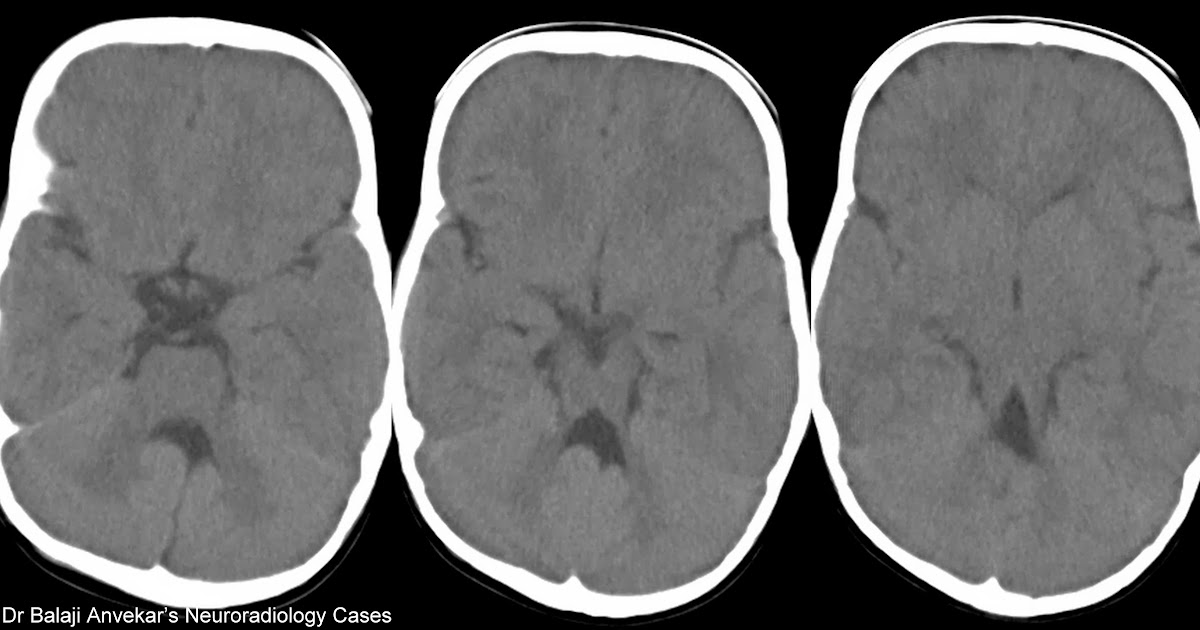 Neuroradiology Cases: Joubert Syndrome CT Brain