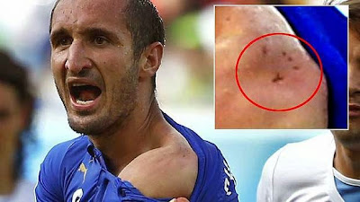 Bite Mark Analysis - Forensicpedia