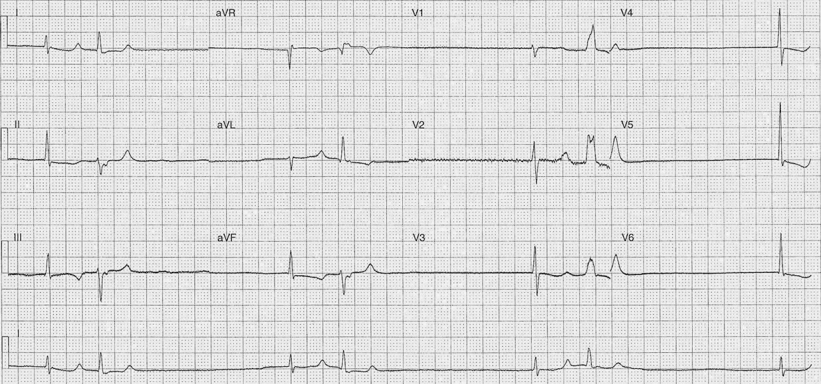 ECG of the Week: ECG of the Week - 22nd April 2013