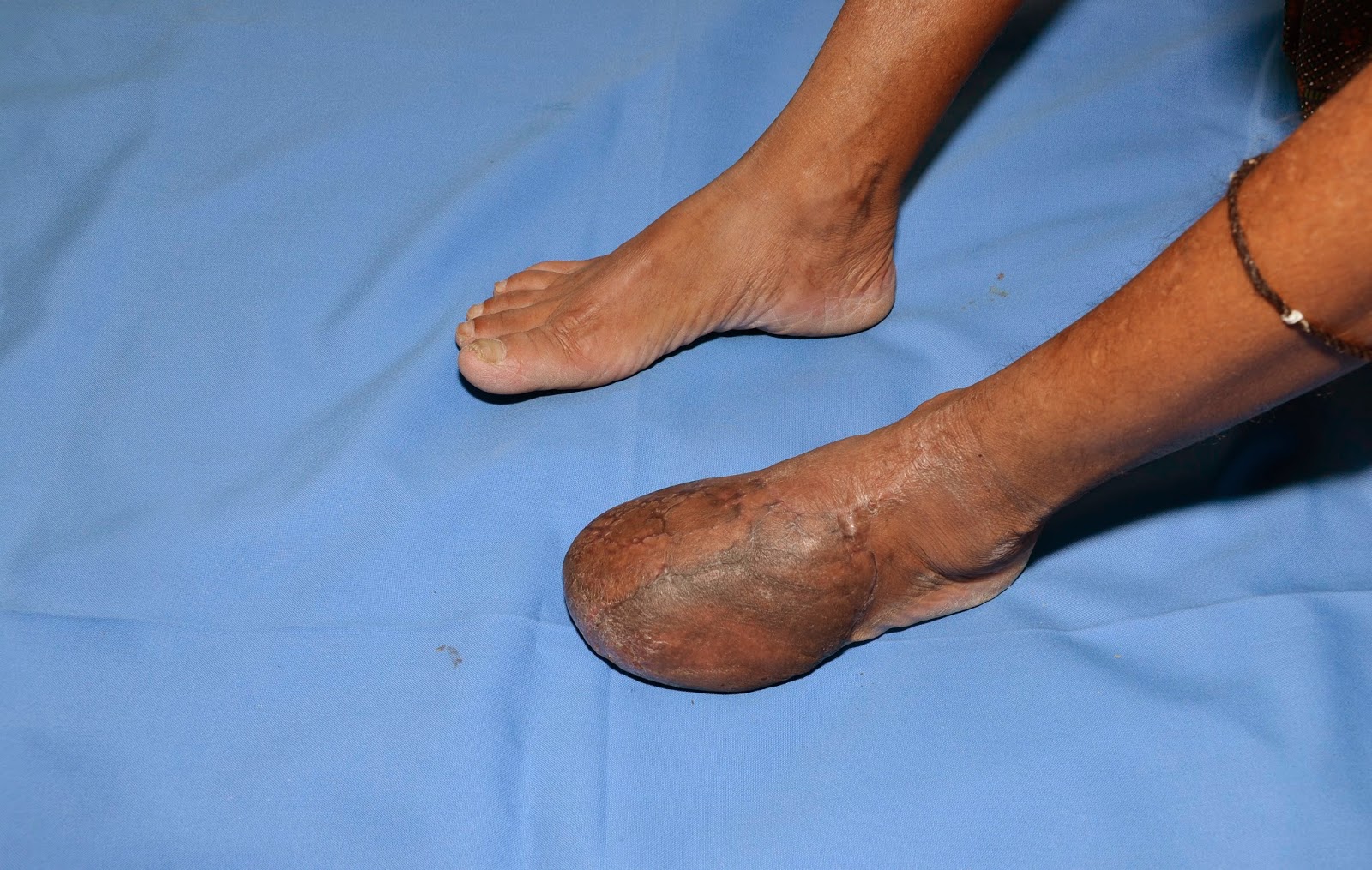 MAJOR CRUSH INJURY FORE FOOT - DEGLOVING OF FOREFOOT - LATISSIMUS DORSI FREE FLAP COVERAGE ...