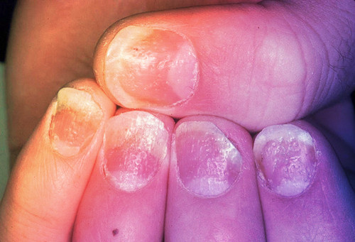 Tratamientos Caseros Contra la Psoriasis Ungueal - Que También ...