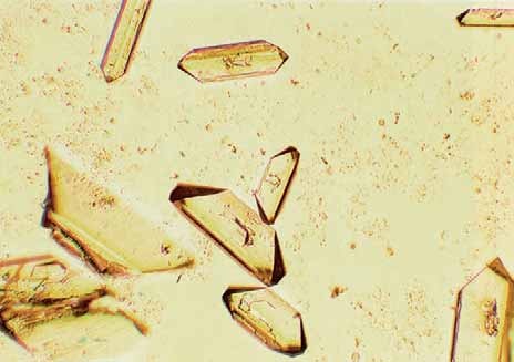 [Haematology] Microscopic Examination of Urinary Sediment - Crystals ...