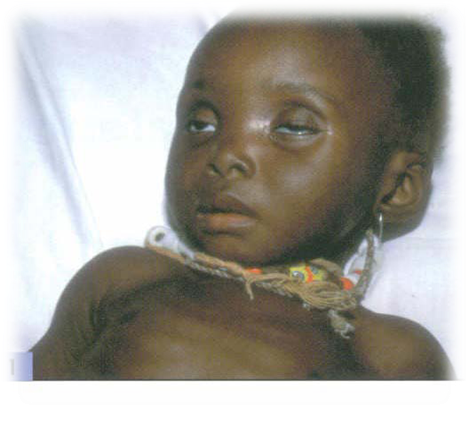 EMERGENCIOLOGÍA: ENFERMEDAD DIARREICA Y DESHIDRATACIÓN EN PEDIATRÍA