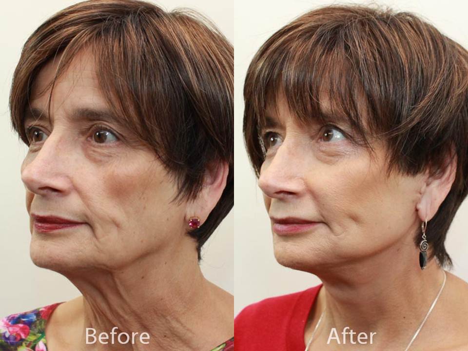 Dr. Darm, Aesthetic Medicine Blog: Fat Transfer and Neck Lift ...