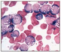 Medical Treatment Pictures-for Better Understanding: Leukemia - Acute ...