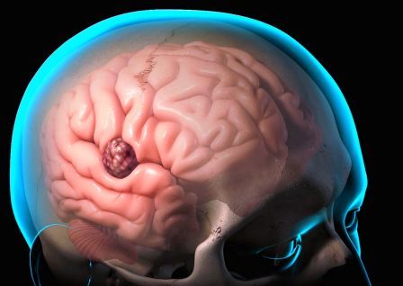 Obat Abses Otak Tradisional Di Apotik