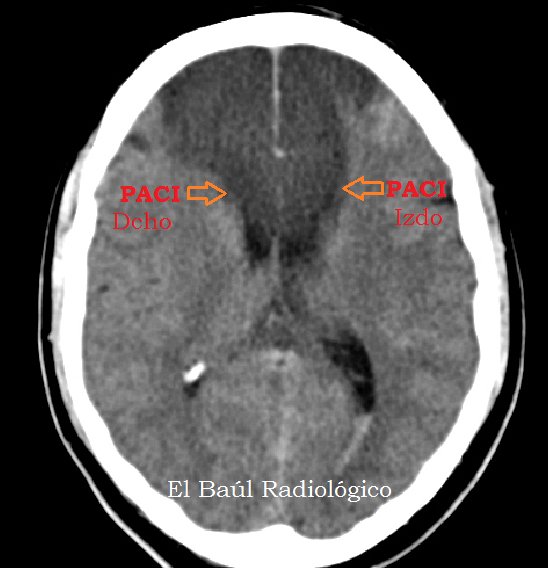 El Baúl Radiológico: ICTUS: UN GALIMATÍAS DE SIGLAS (Stroke: A ...