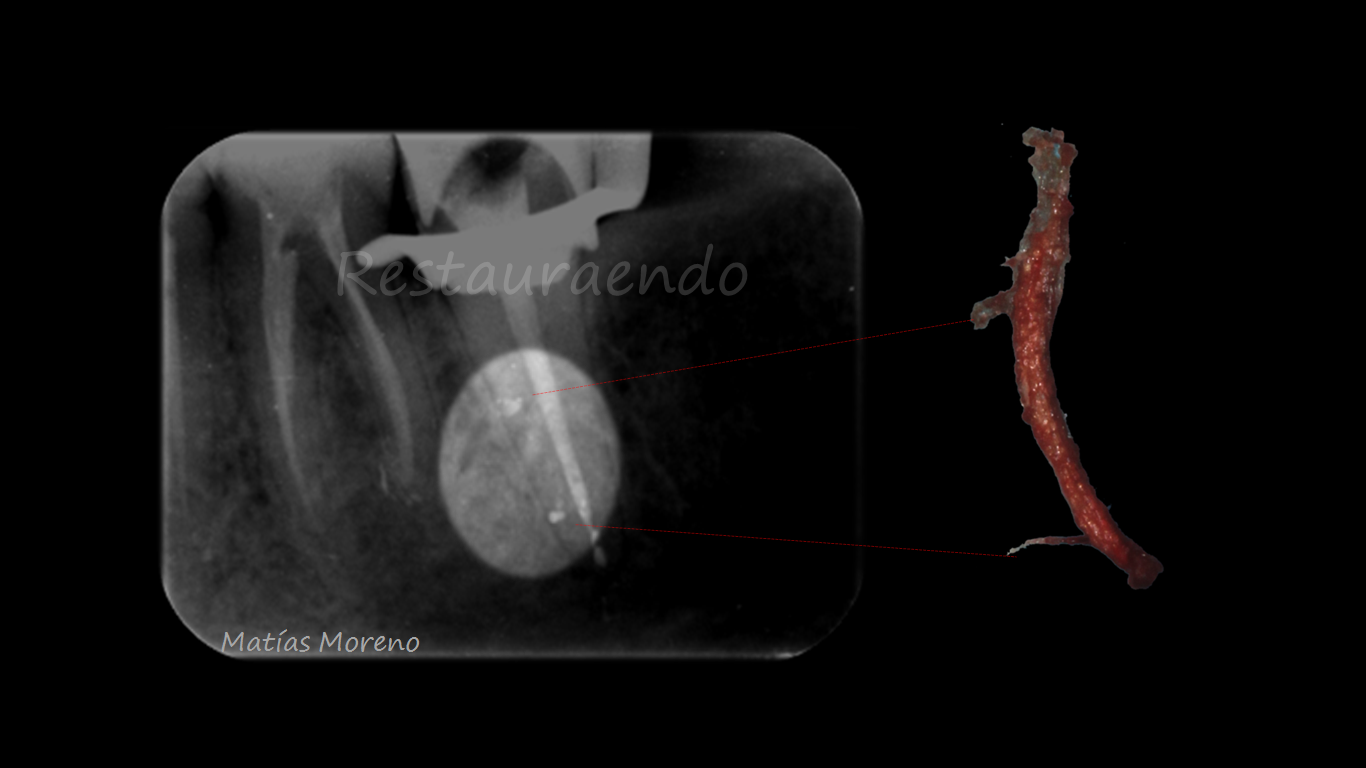 Máster en Odontología Restauradora y Endodoncia: Tratamiento de ...