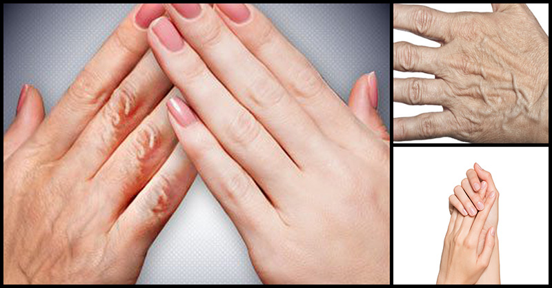 Home Remedies For Wrinkled Hands | Dr Farrah MD