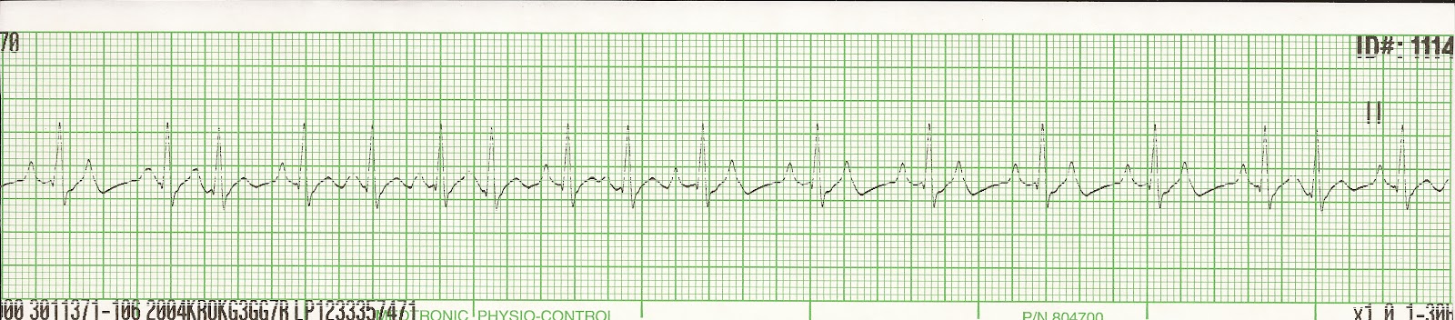 Float Nurse: EKG Rhythm Strip Quiz 53: Atrial Rhythms