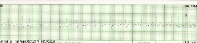 EKG Rhythm Strip Quiz 53: Atrial Rhythms
