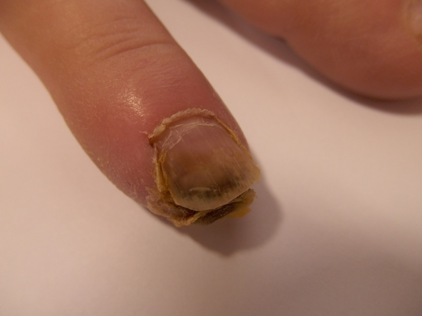 Rheumatologe: Limited Scleroderma