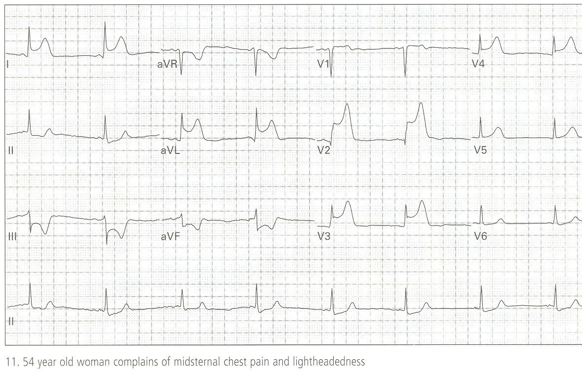 ECGs for EMS: Identification and Localization of STEMI: ANTERIOR WALL