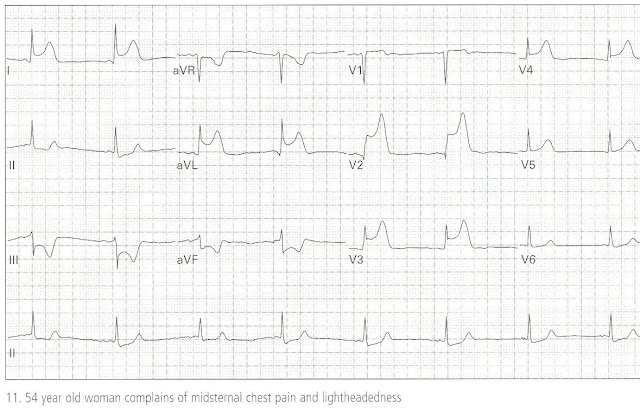 ECGs for EMS: Identification and Localization of STEMI: ANTERIOR WALL