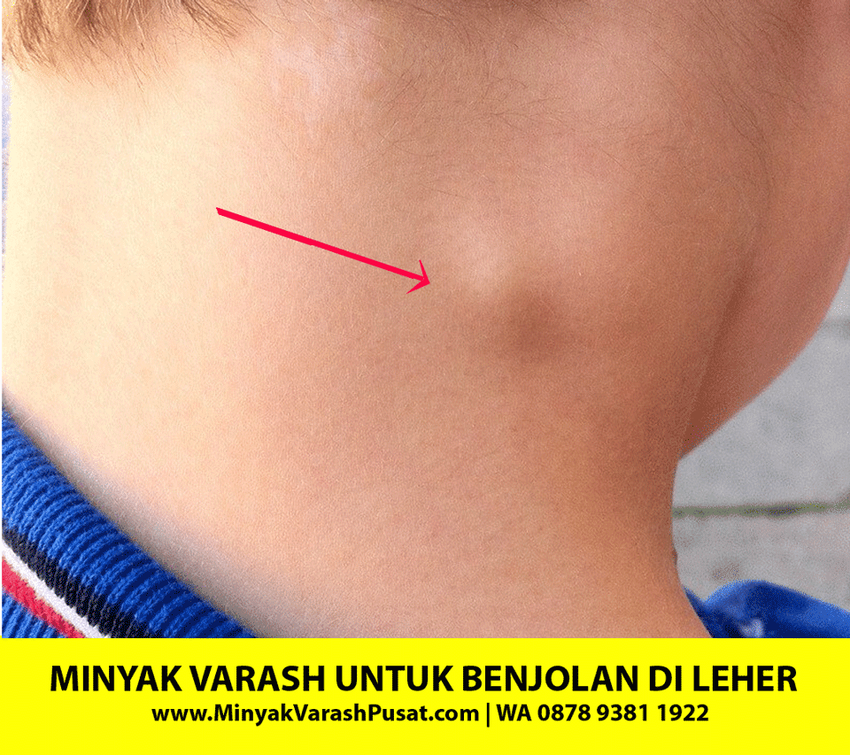 Terapi Benjolan Di Leher Ketiak Belakang Telinga Dengan Varash