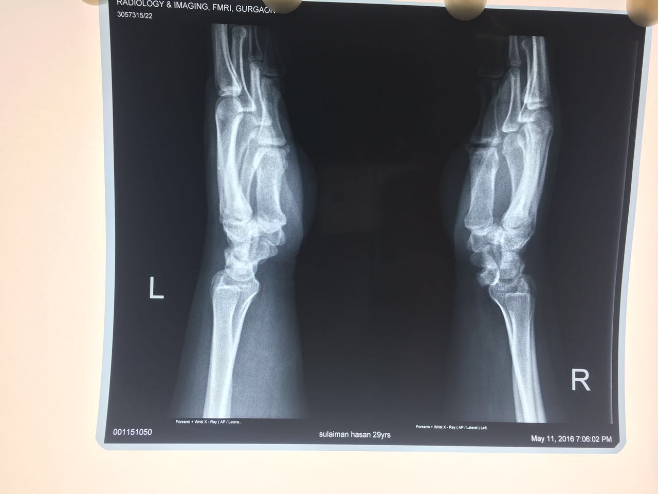 proximal row carpectomy