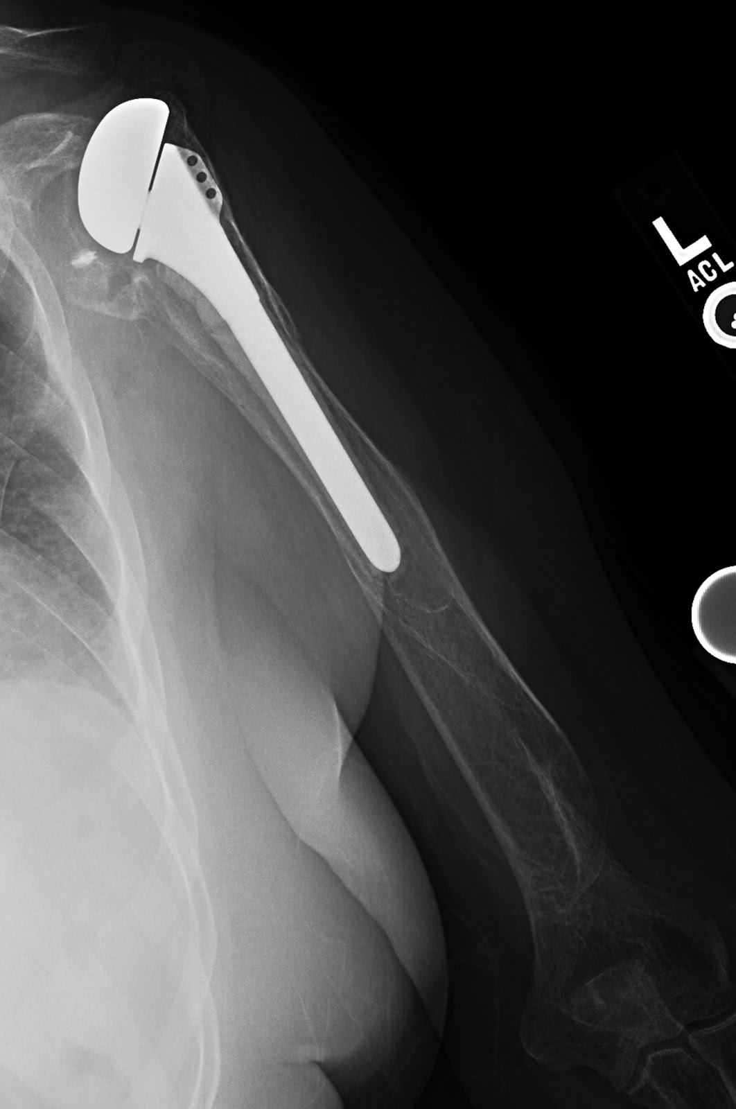 Shoulder Arthritis/Joint Replacement Rotator cuff tears: Shoulder joint ...