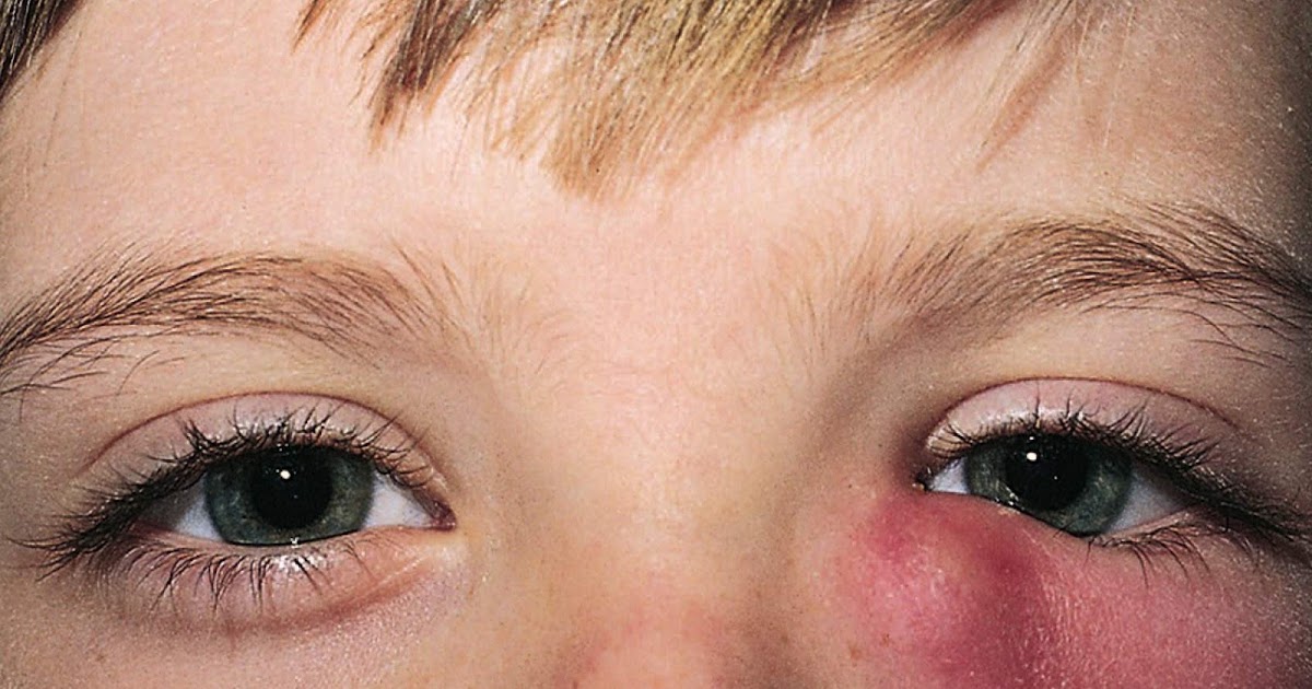 Study Medical Photos: Dacryocystitis - Clinical Features And Management.
