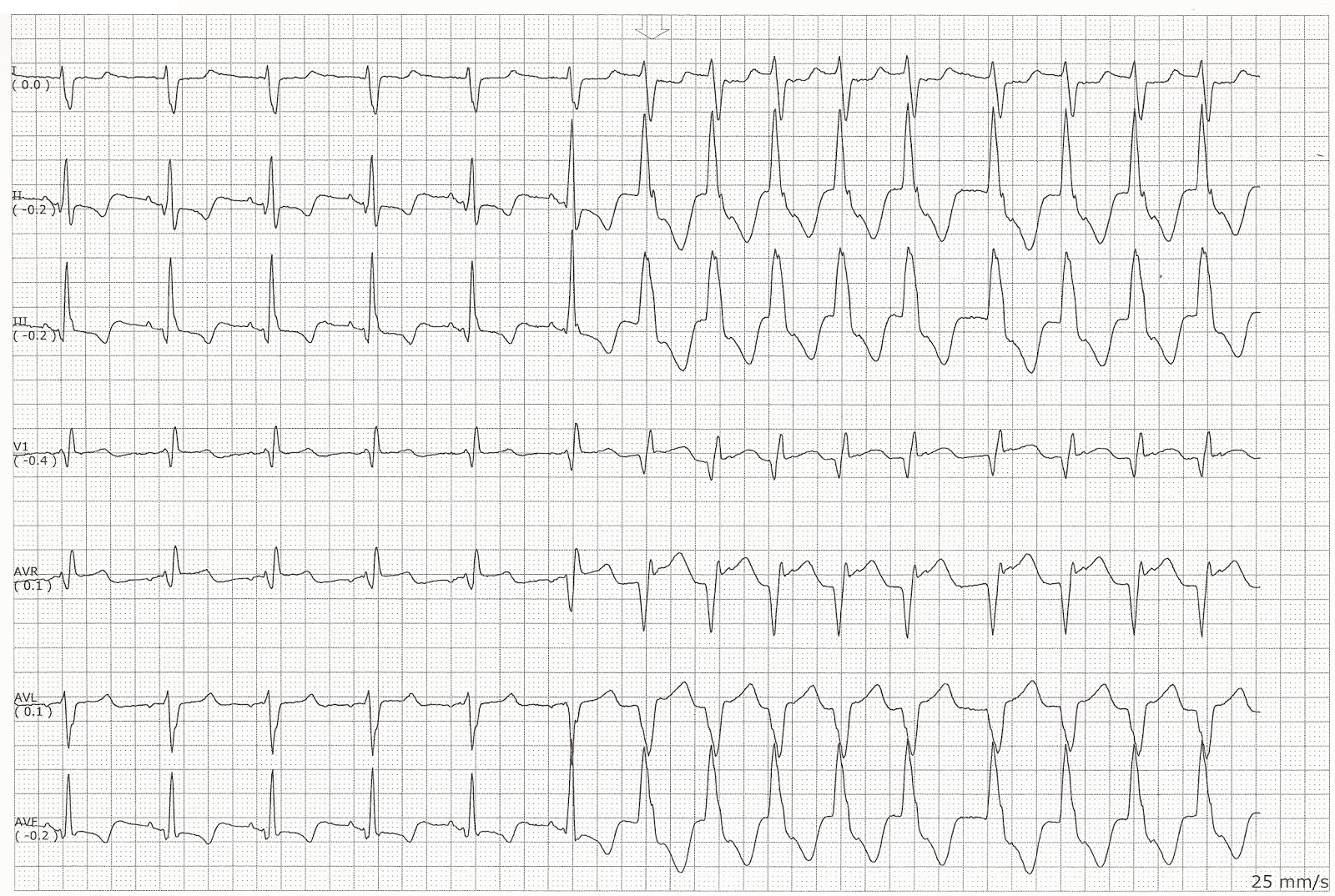 Float Nurse: Sinus rhythm with a run of VT