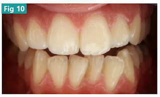 Molar Incisor Hypomineralization (MIH): Conservative Treatment Approach