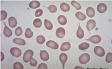 Hematología: Anormalidades Eritrocitarias
