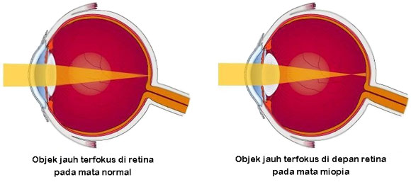 Penyakit Mata: Rabun Jauh (Miopia) | Medkes