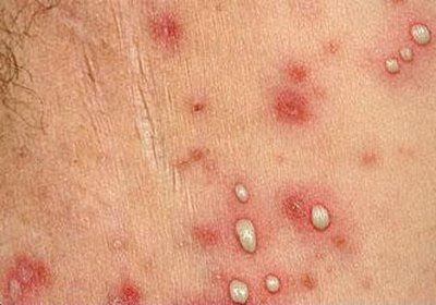 Apuntes Sobre Semiología Quirúrgica: Principales Lesiones Cutáneas