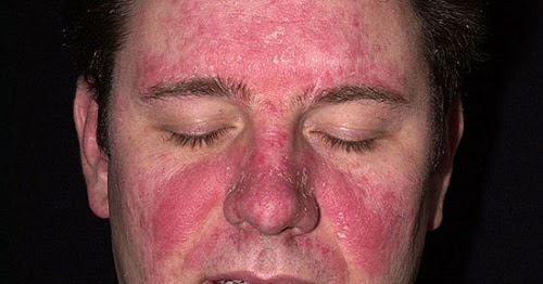 Remedios Caseros para la Psoriasis Facial | Como Curar la Psoriasis en ...