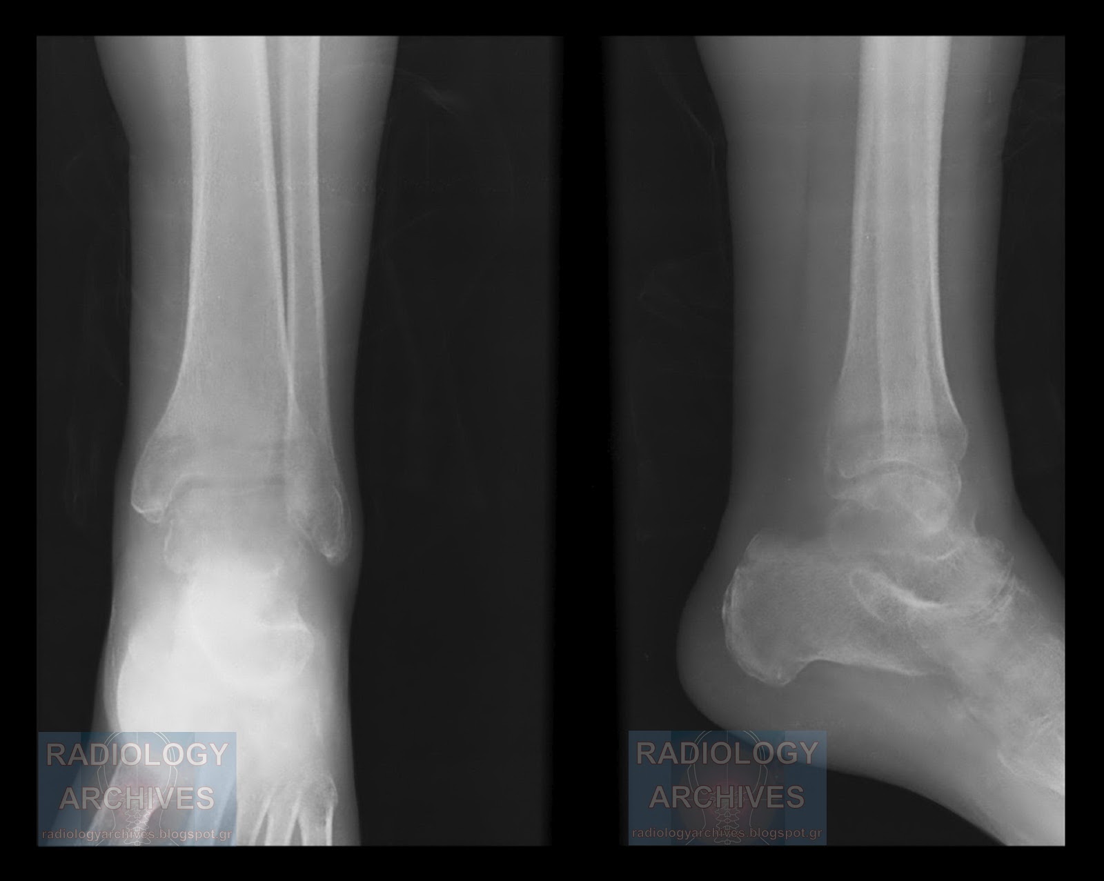 Radiology Archives: Ατροφία Sudeck