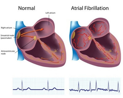 MedFriendly Medical Blog: Atrial Fibrillation and Its Common Signs and ...