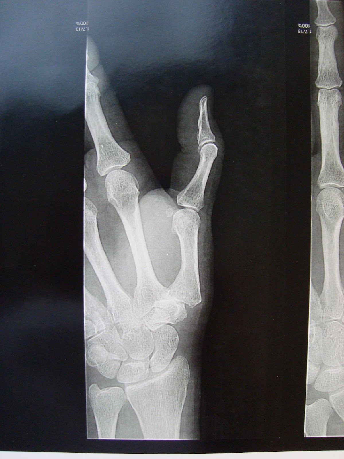 Orthèses sur mesure et appareillage personnalisé main poignet doigts ...