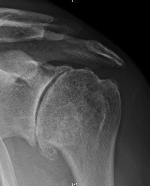 UW Shoulder and Elbow Academy: Perfectly executed forward lean table ...