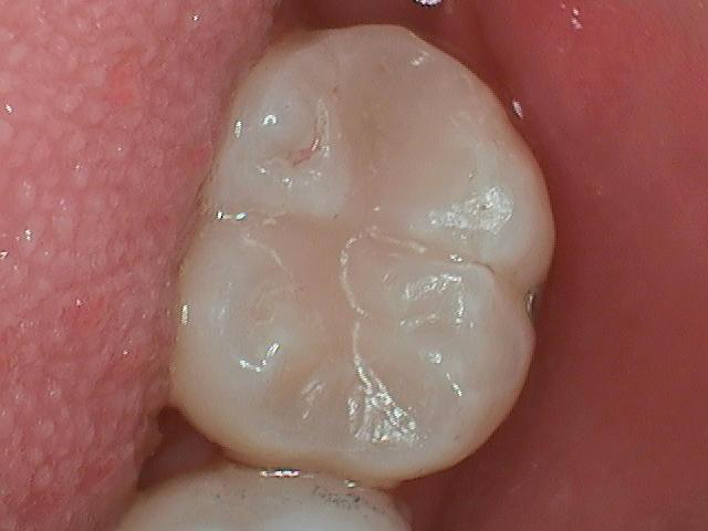 sweet tooth: distal decay on 2nd molars.