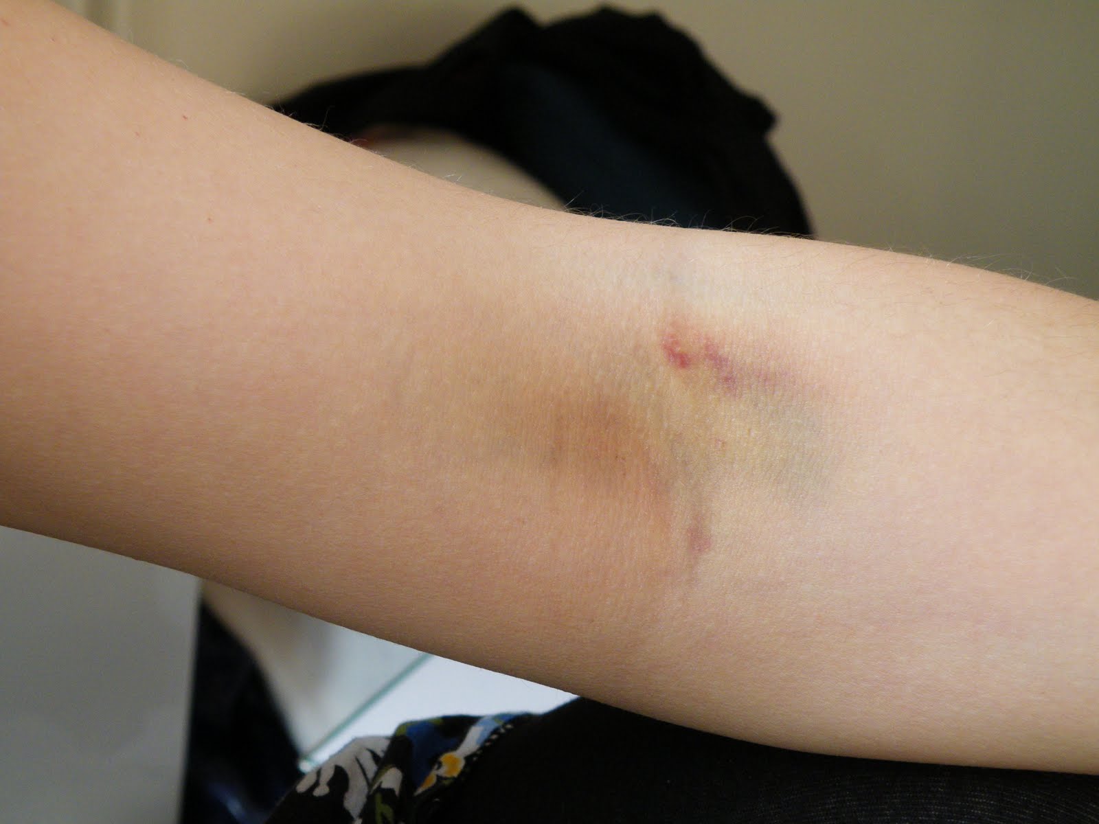 Midnight Radio: Blood groups and bruises