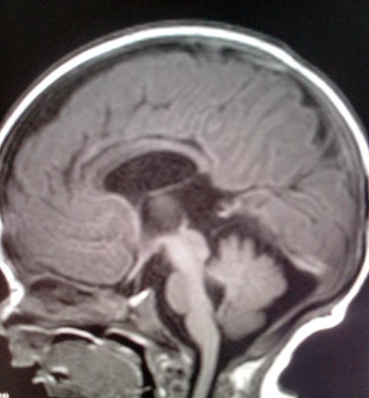 Polymicrogyria-MRI - Sumer's Radiology Blog