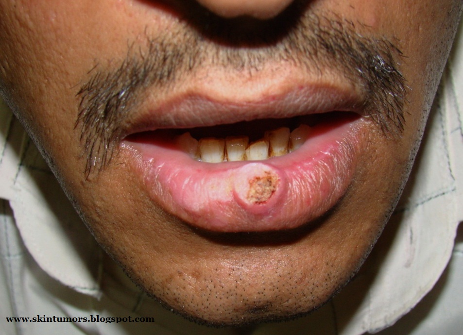 Skin Tumors: KA on the lip
