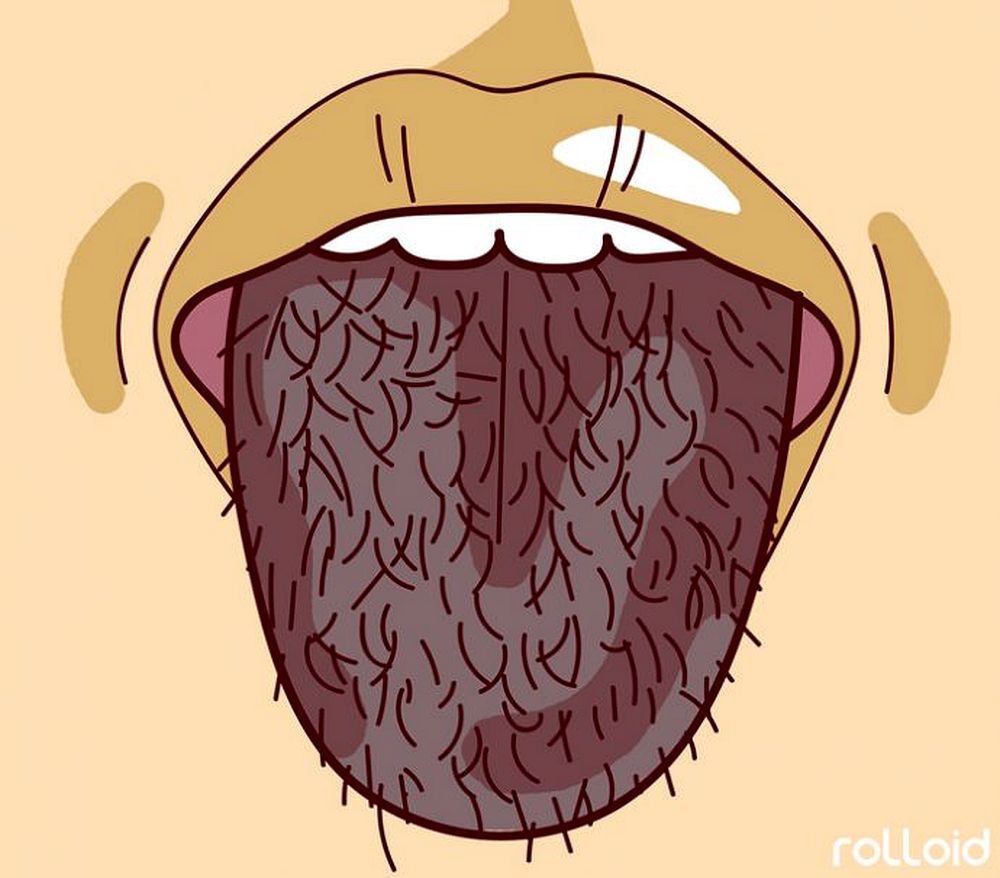 PATOLOGÍA : Tratamiento de la lengua negra vellosa | Directorio ...