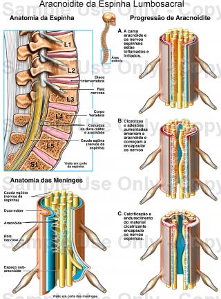 Coluna do Militar - Blog: Aracnoidite