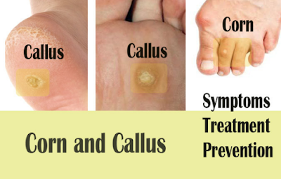 How To Get Rid Of Callus On Feet - Caraway Seeds Health Benefits