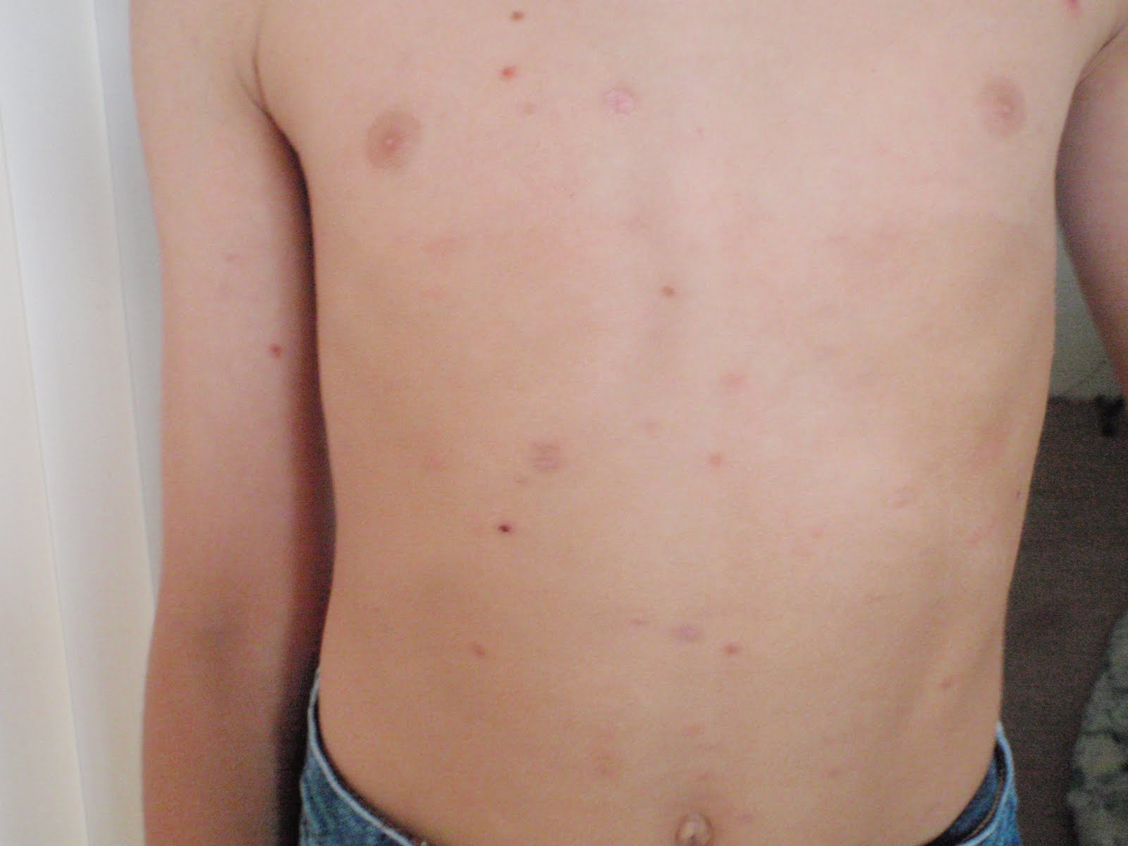 Our Battle with PLEVA or Mucha-Habberman's disease...Finally found a cure!