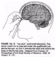 IB psychology!: Frontal Lobotomy