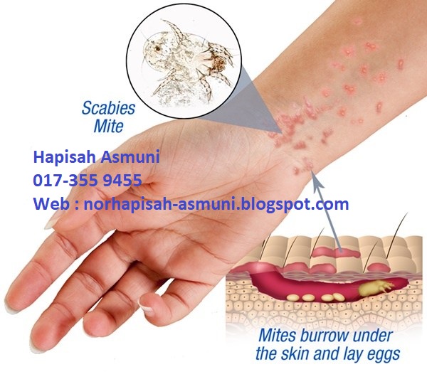 PENGEDAR SHAKLEE YANG PALING AKTIF: CARA BERKESAN ATASI MASALAH KUDIS ...