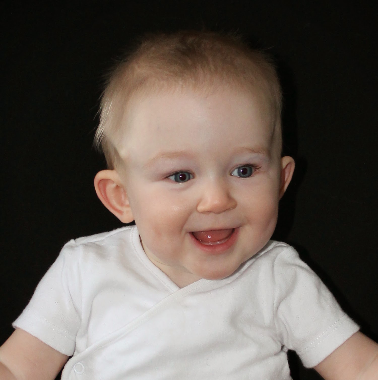 Leah's Right Coronal Craniosynostosis: Distractor Turning