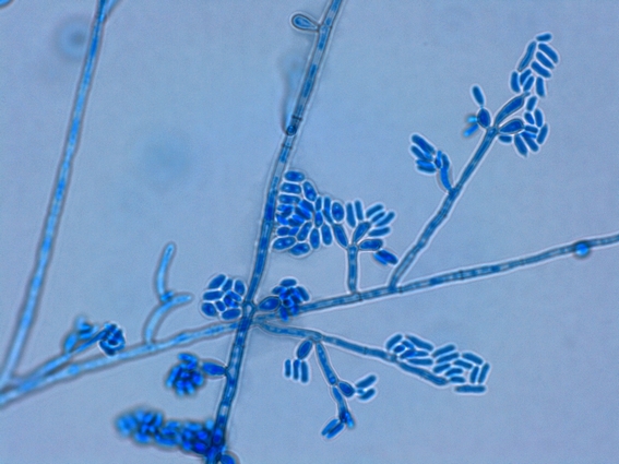 Fun With Microbiology (What's Buggin' You?): Exophiala dermatitidis