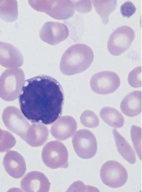 [Haematology] Abnormalities of the White Cell Series | Free Medical Atlas