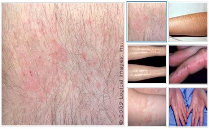 SEMIOBLOG HUMANITAS: Xerodermia