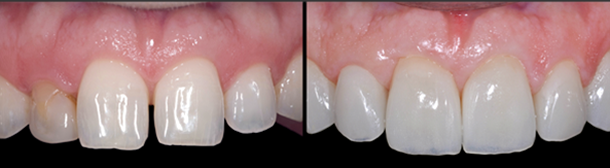 FAMILY CARE DENTAL: Diastema